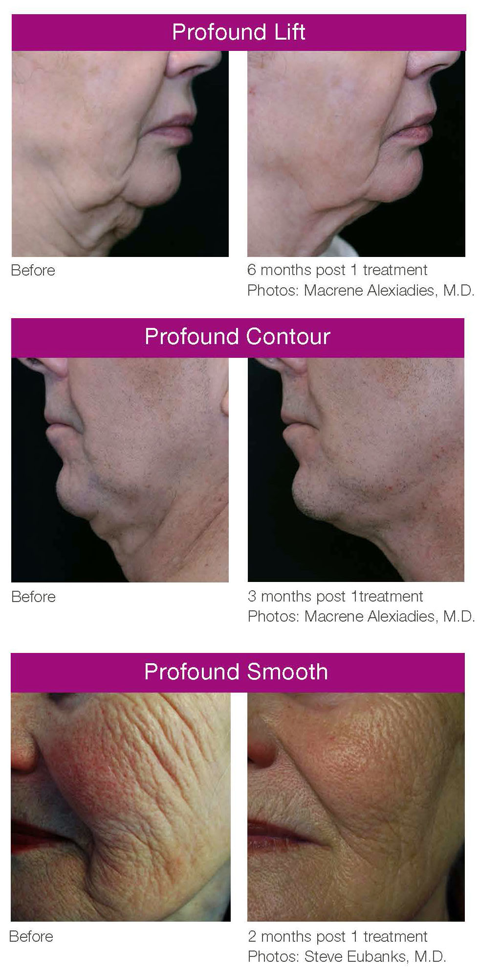 Profound Huntington beach | Best Nonsurgical Facelift Huntington Beach ...